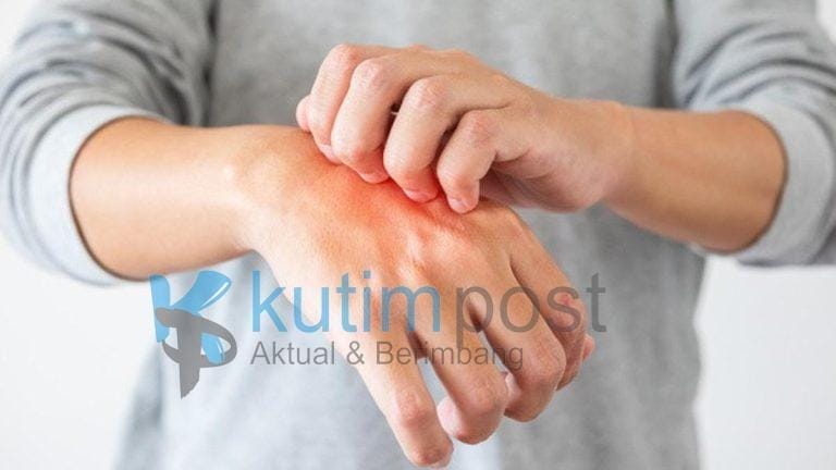 Gatal-Gatal dan Ruam Kulit Karena Stres, Kok Bisa? » Kutim Post